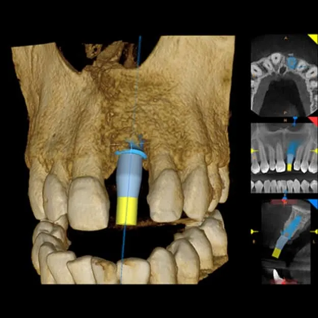 Guided surgery with our CT scanner - Kidsgrove Dental & Implant Centre ...