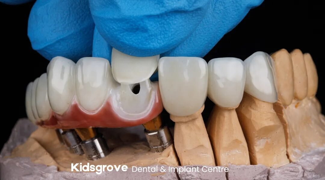 Dental Crowns Explained: Types, Benefits, and Maintenance - Kidsgrove ...